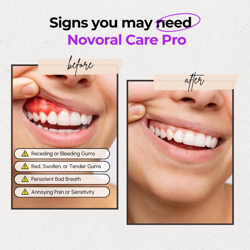 Heal Periodontal Treatment and Receding Gums - Novaa Oral Care Pro ...